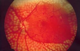 Treatment for diabetic retinopathy - Macular Disease Foundation ...