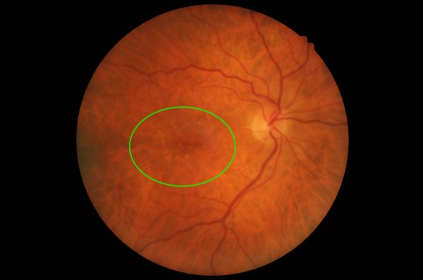 Stages of age-related macular degeneration | Macular Disease Foundation
