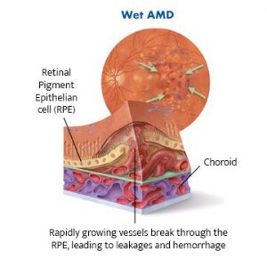 What is Age-Related Macular Degeneration? | Macular Disease Foundation ...
