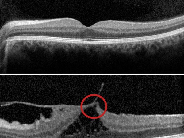 Vitreomacular traction syndrome - Macular Disease Foundation Australia ...