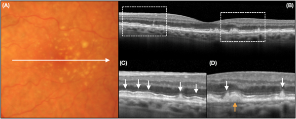 Reticular pseudodrusen in AMD: Update for optometrists - Macular ...
