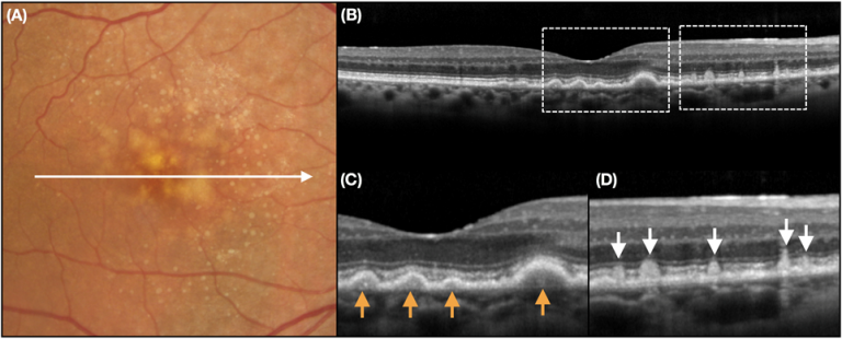 Reticular pseudodrusen in AMD: Update for optometrists - Macular ...