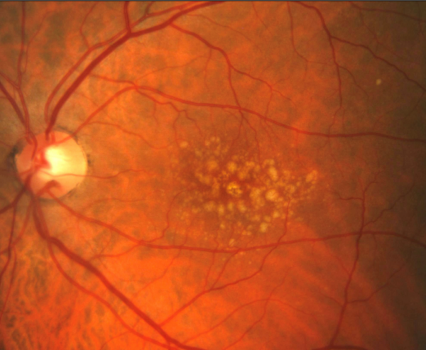 Everything you need to know about age-related macular degeneration