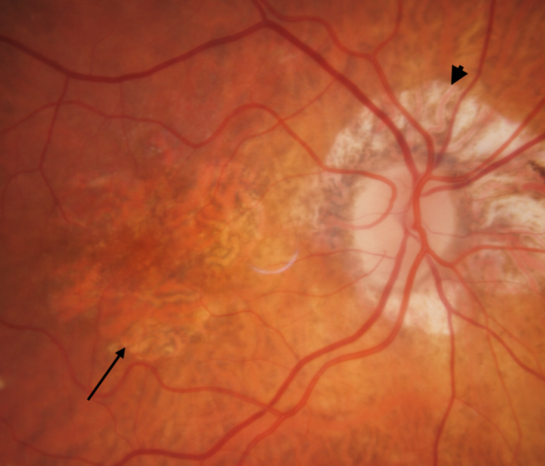 Everything you need to know about age-related macular degeneration