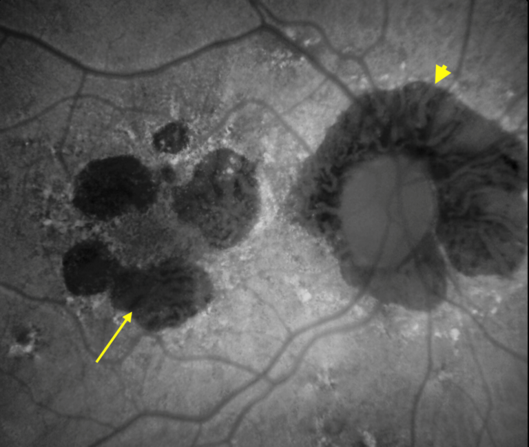 Everything you need to know about age-related macular degeneration