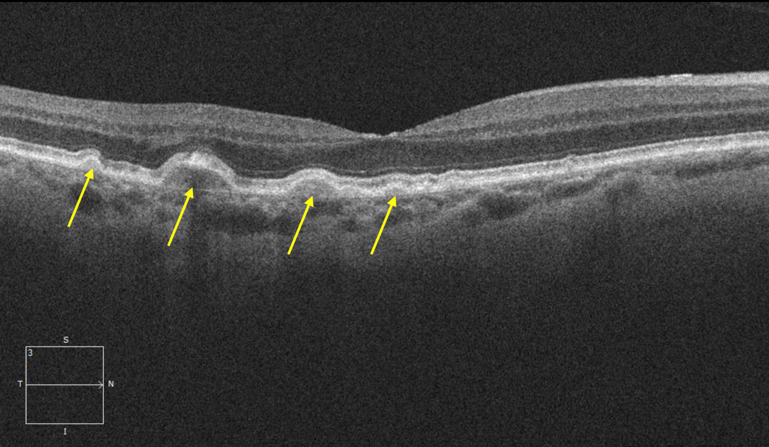 Everything you need to know about age-related macular degeneration