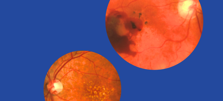 Retinal vein occlusion | Macular Disease Foundation Australia Macular ...